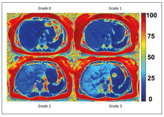 Hepatic Fat Concentration Evaluated By Magnetic Resonance Imaging In